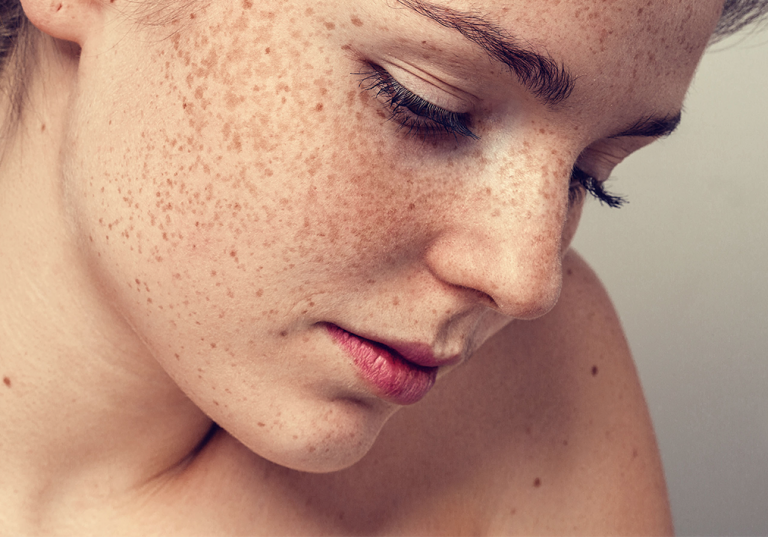 Melasma: Causas, tratamentos e como evitar estas manchas no rosto!
