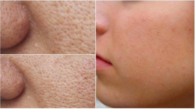 7 dicas de como tratar poros abertos e deixar sua pele mais saudável ...