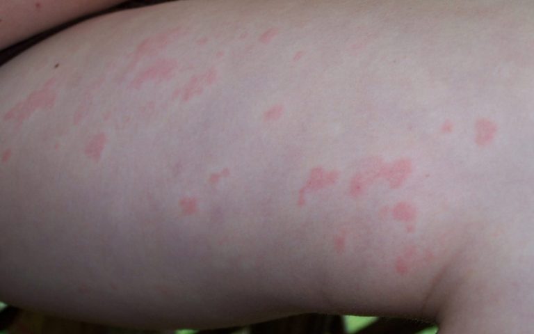 Quimica da Gabi: Urticária: causas, sintomas, cuidados e tratamentos