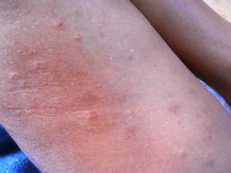 Quimica da Gabi: Impingem (dermatofitose): causas, sintomas e tratamentos